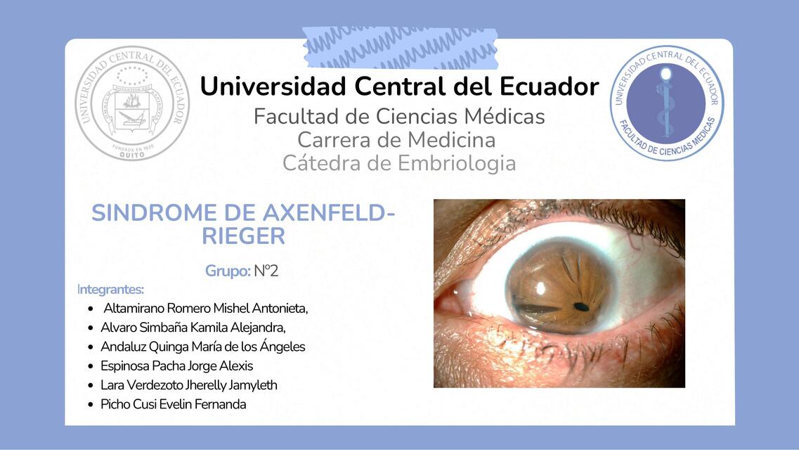 Sindrome de Axenfeld rieger | Mishel | uDocz