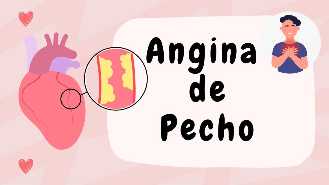 Flashcards de angina de pecho | Por Brigitt | uDocz