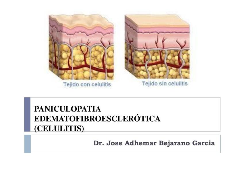 celulitis pefe adhe | LU | uDocz