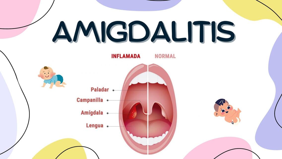 AMIGDALITIS | claudia mejia | uDocz