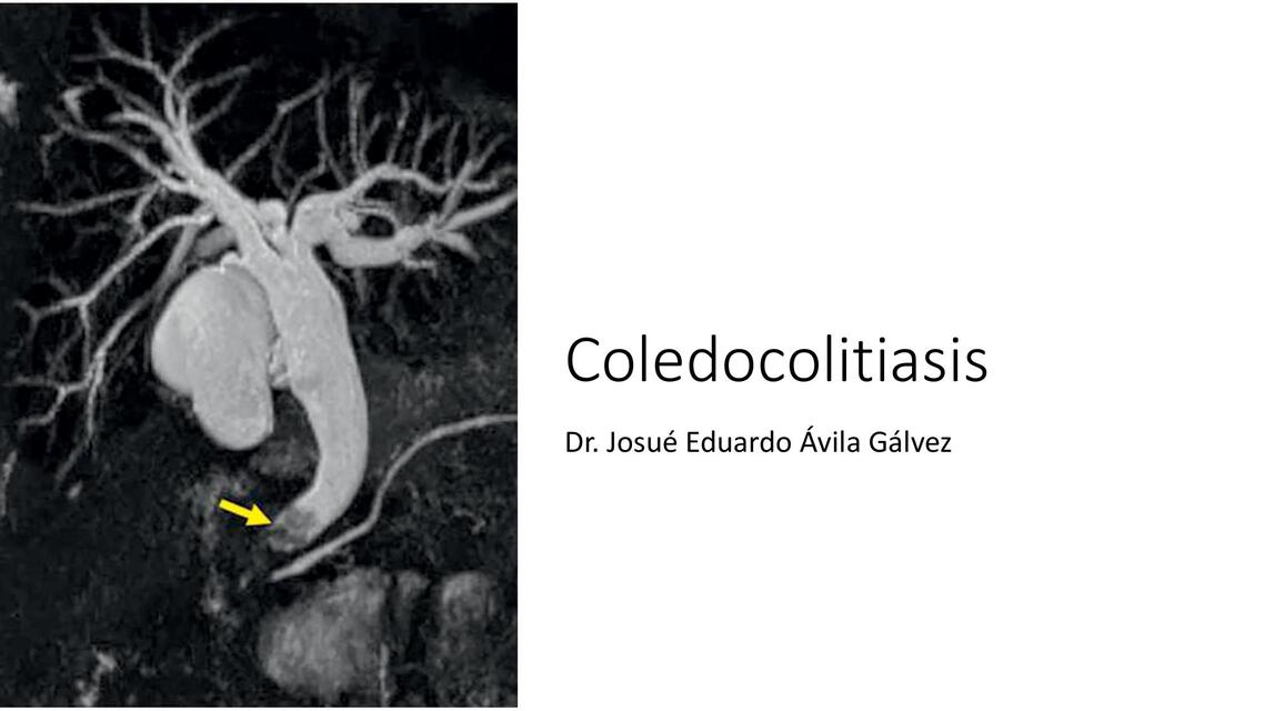 Coledocolitiasis | | uDocz