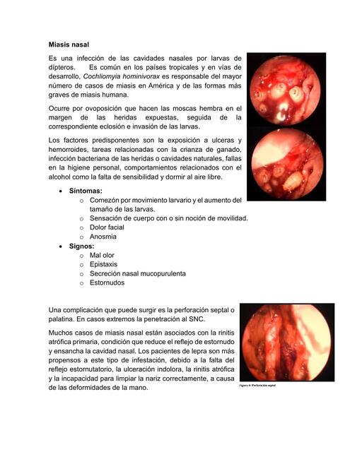 Miasis nasal | ORLANDO JOSHUA TORRES MORENO | uDocz