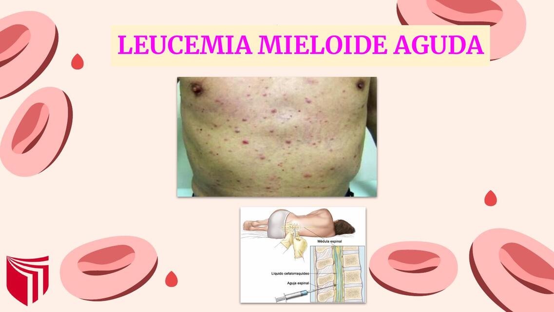 LEUCEMIA MIELOIDE AGUDA | Javier MARIN | uDocz