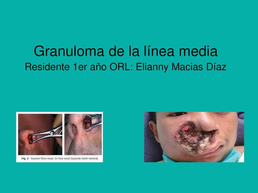 Granuloma de la línea media | Elianny Macias Díaz | uDocz