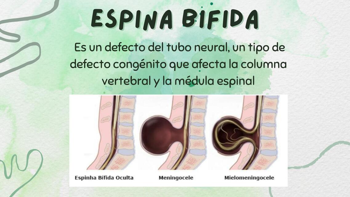 Espina bífida | Shirley Dayana Rueda Moncada | uDocz