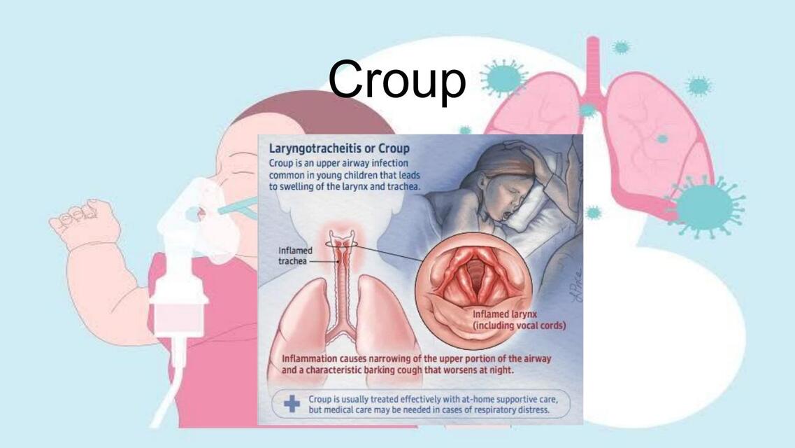 Croup | CARLOS ENRIQUE JESUS | uDocz