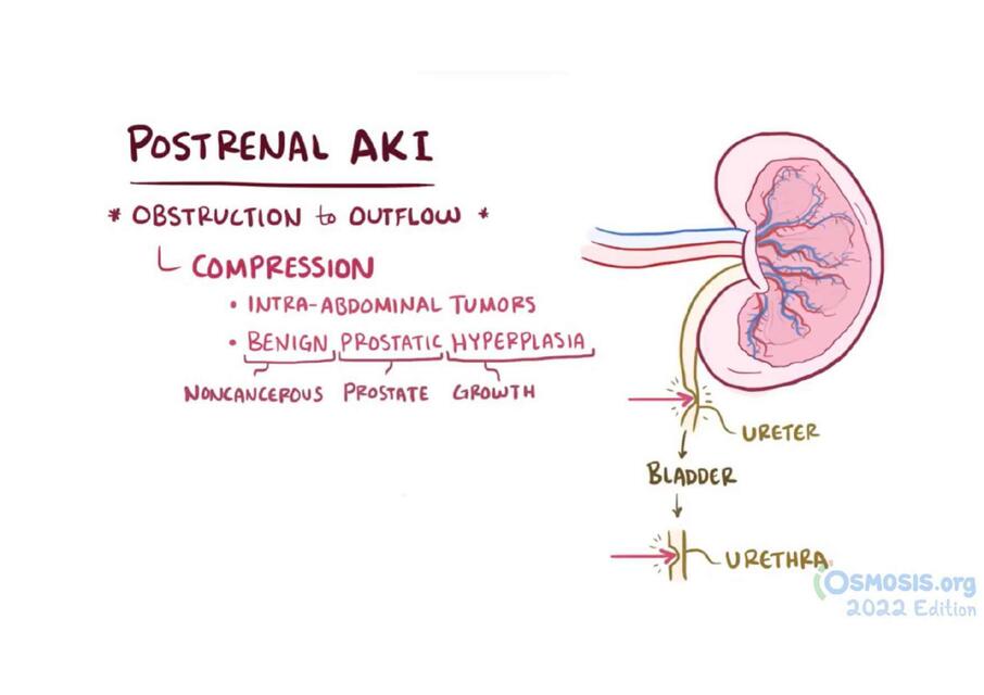 Flashcards de IRA Postrenal | Por Anna Sara | uDocz