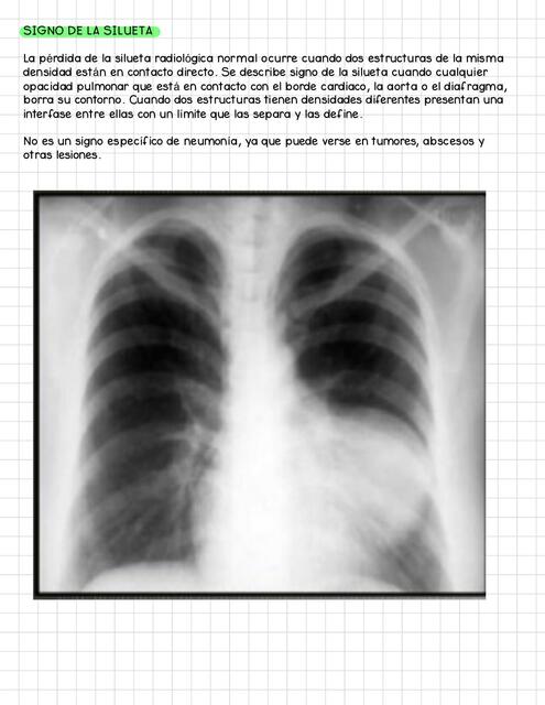 20 signos radiológicos de tórax | Aline Perez | uDocz