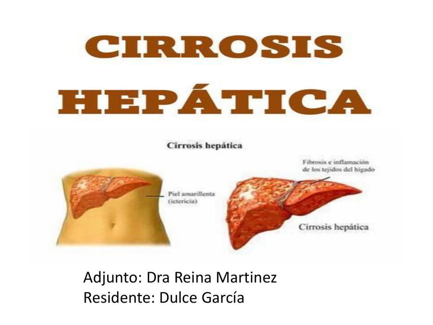 cirrosis | Mayra narvaez | uDocz