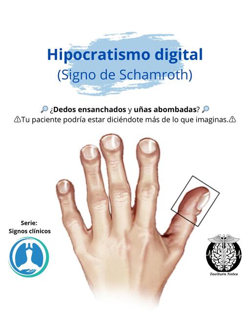 Hipocratismo digital Signo de Schamroth | Taciturn Notes | uDocz