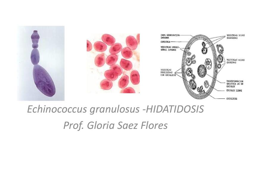 Hidatidosis | Ahmed Casana | uDocz