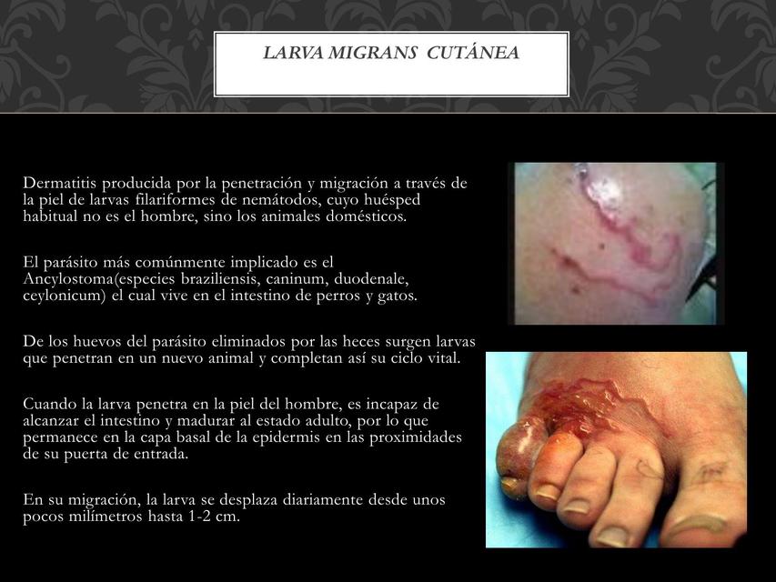 Larva Migrans Cutánea | Ahmed Casana | uDocz