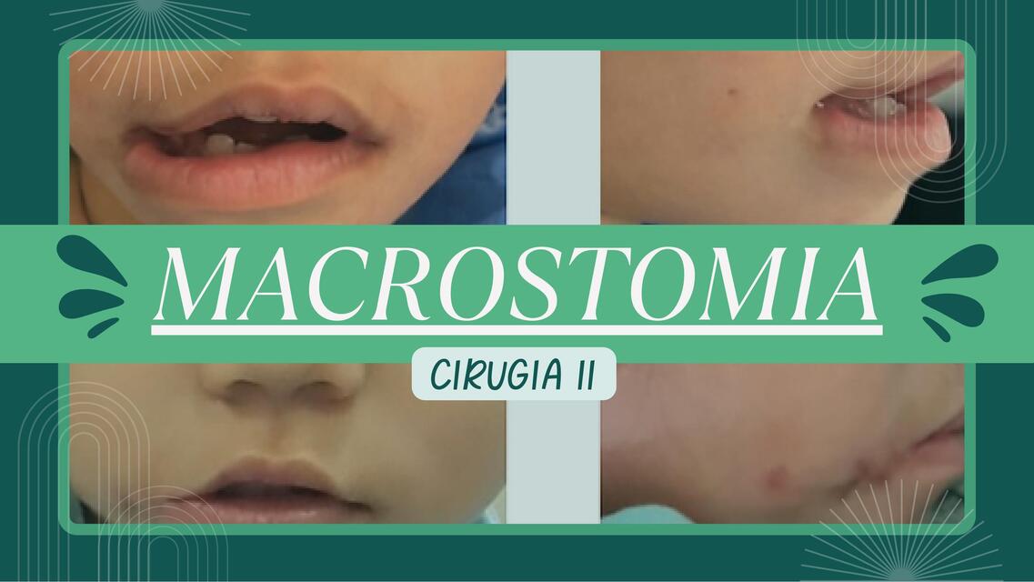 macrostomia | Emily Andrea Ayllon Rios | uDocz