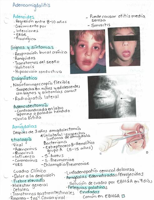 Adenoamigdalitis | Fer Yan Márquez | uDocz