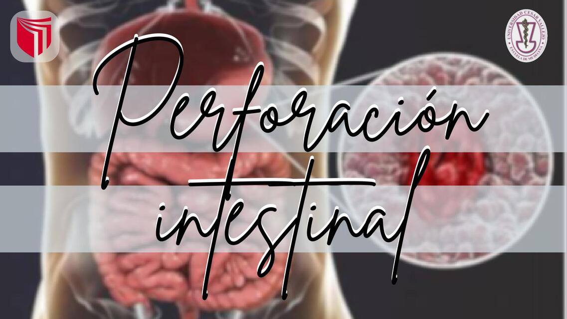 PERFORACIÓN INTESTINAL-CIRUGIA | Sheyla Xiomara | uDocz