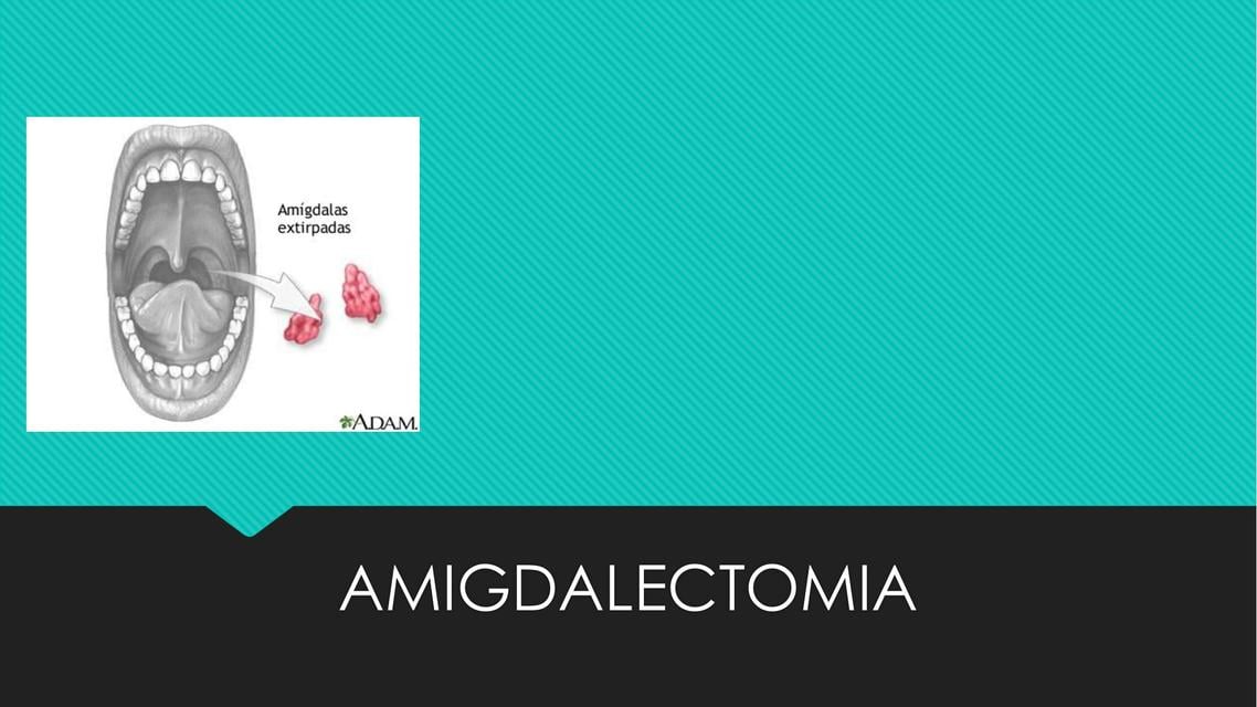 Amigdalectomía | Enfermería | uDocz