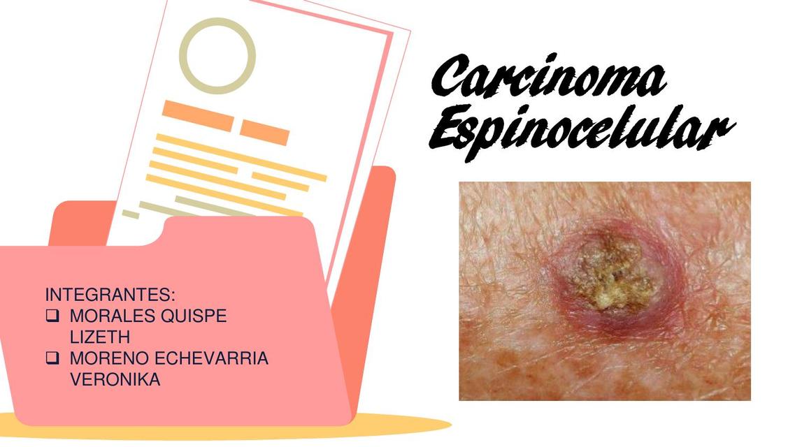 Carcinoma Espinocelular | Morales Lizeth | uDocz