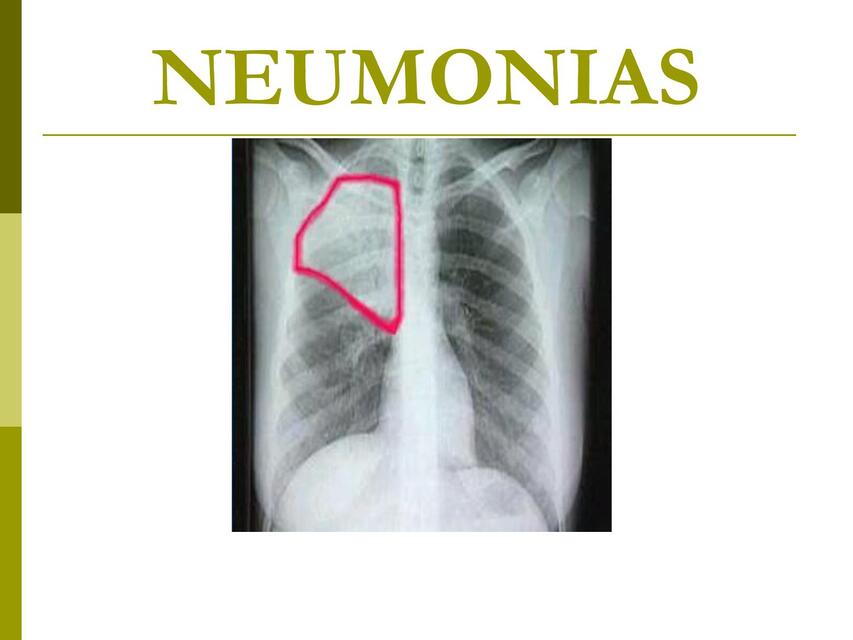 NEUMONIA | Brenda Arely | uDocz