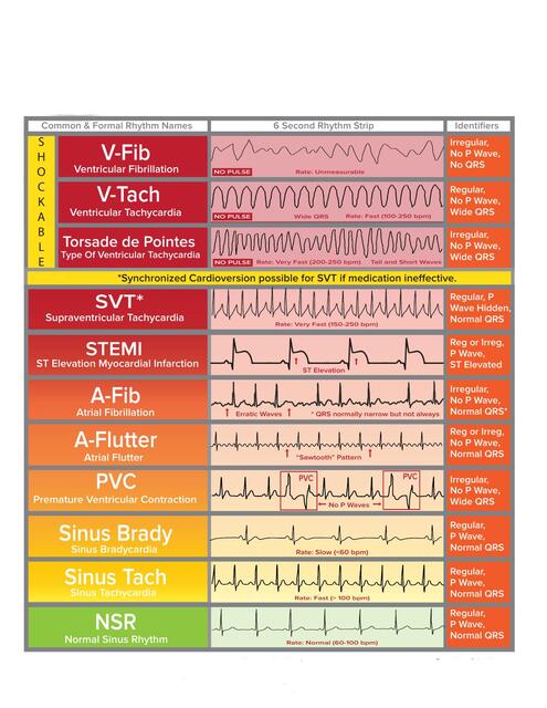 basic ekg ecg rhythms cheatsheet copy 1 | Andres | uDocz