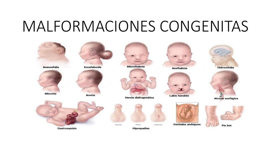 malformaciones congenitas del RN | Eduardo Useche | uDocz