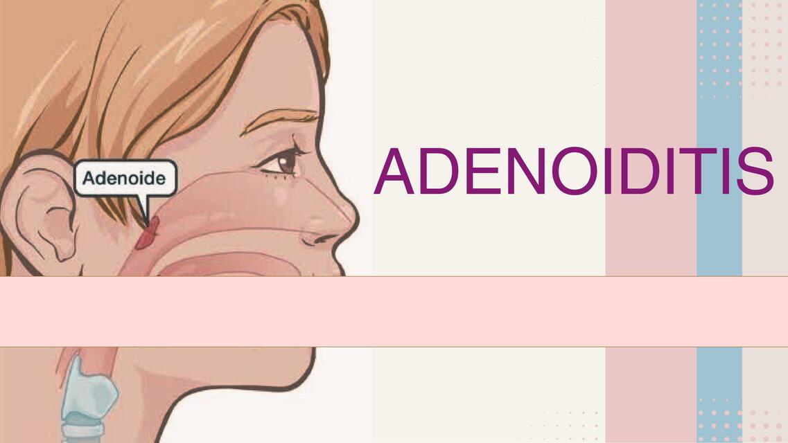 Flashcards de Adenoiditis | Por Mabel | uDocz