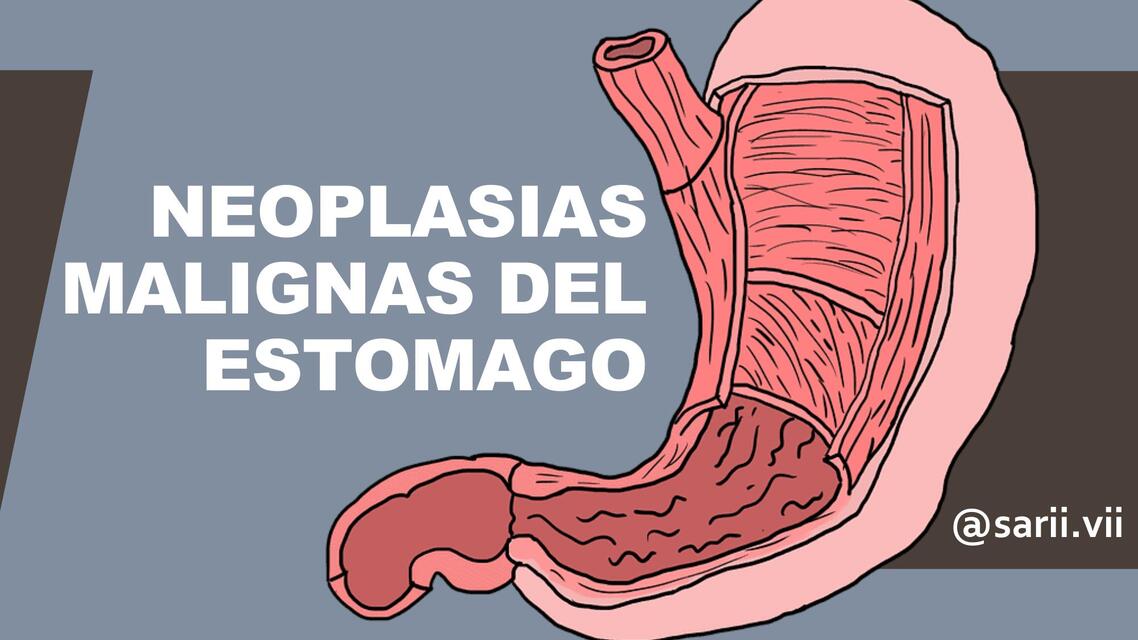 Neoplasias Malignas del Estómago | Sara Vicente | uDocz