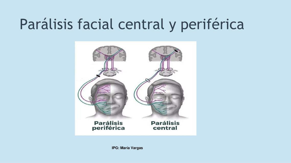 paralisis facial central y periférico | Ángeles | uDocz