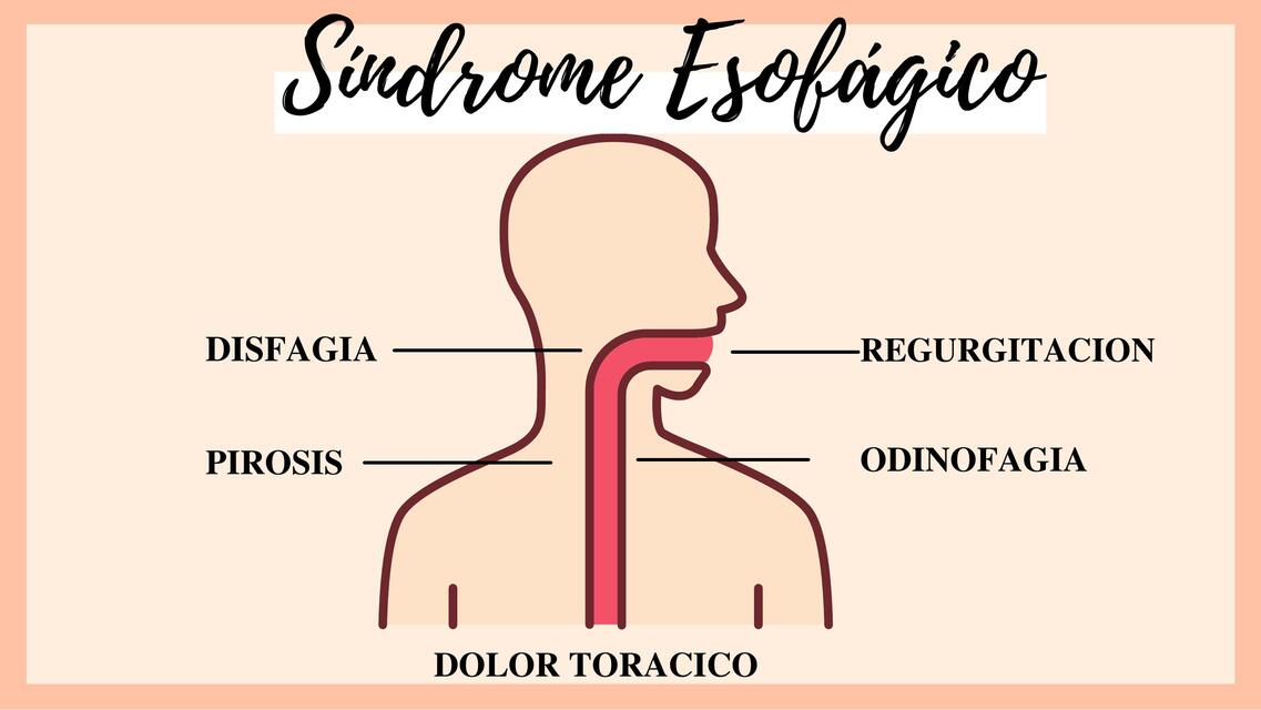 Síndrome esofágico | Mednotes | uDocz