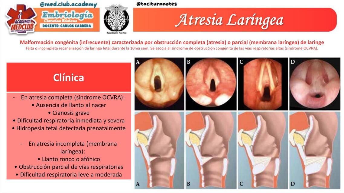 Atresia Laríngea | Taciturn Notes | uDocz