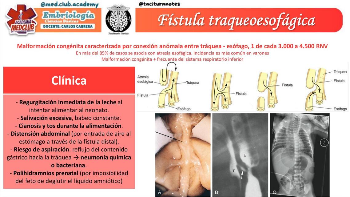 Fístula traqueoesofágica | Taciturn Notes | uDocz