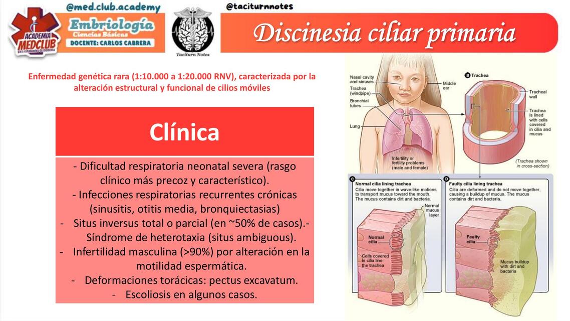 Discinesia Ciliar Primaria | Taciturn Notes | uDocz