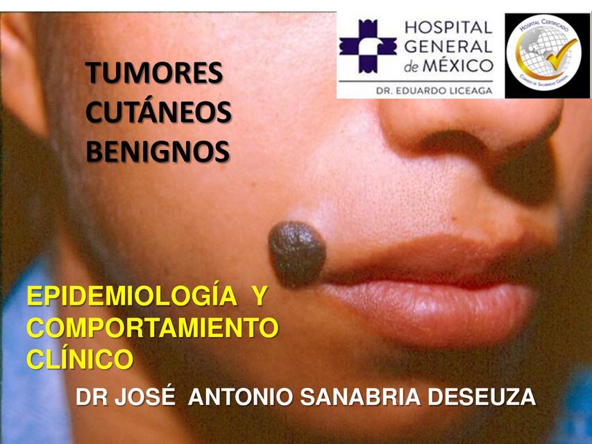Tumor Benigno | Medicine226 | uDocz