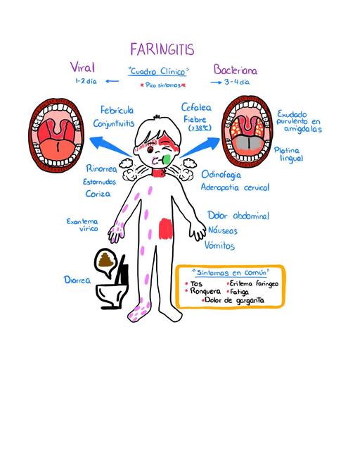 Faringitis viral vs bacteriana | V_1406 | uDocz