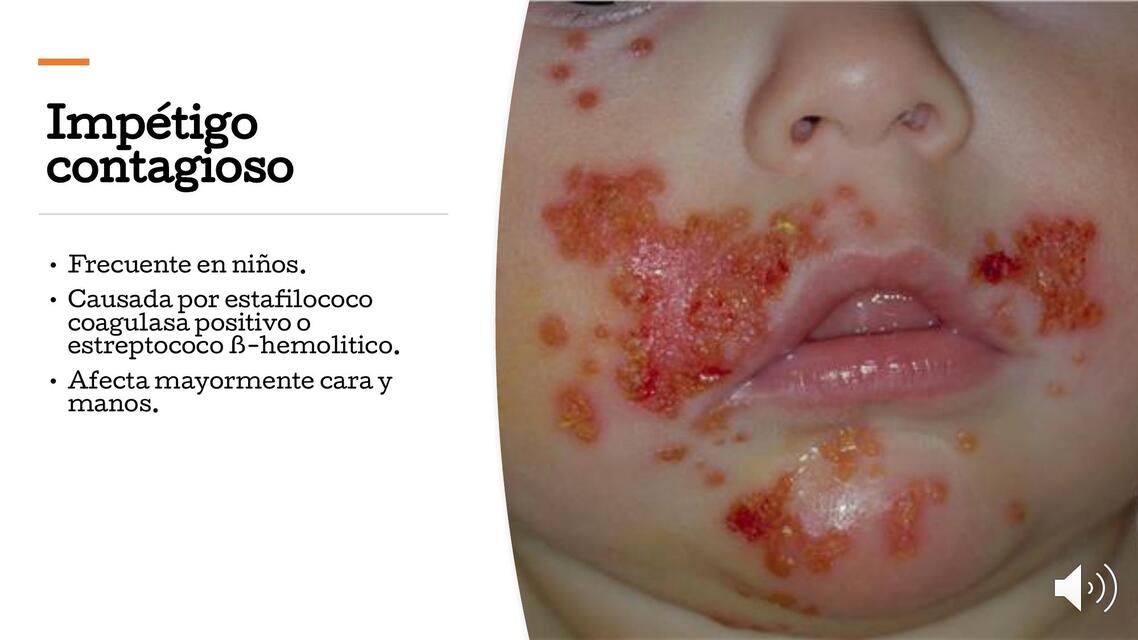 impetigo contagioso | Dra. Batista | uDocz