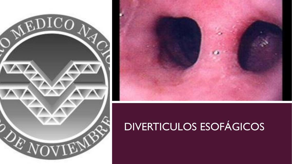 Divertículos esofágicos | Medicine226 | uDocz