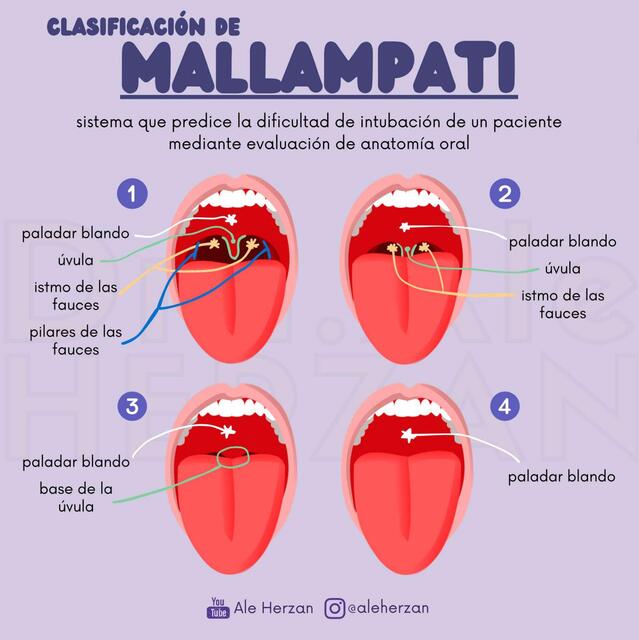 Flashcards de CLASIFICACION DE MALLAMPATI | Por Dra Ale Herzan | uDocz