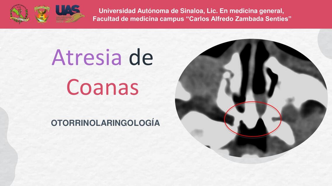 Atresia de coanas | Yesica Isabel | uDocz