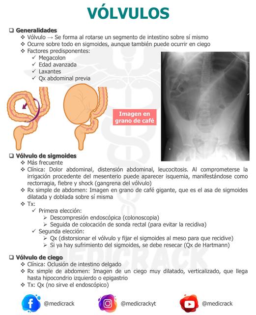 Resúmenes de Vólvulo de sigmoides | Descarga apuntes de Vólvulo de ...