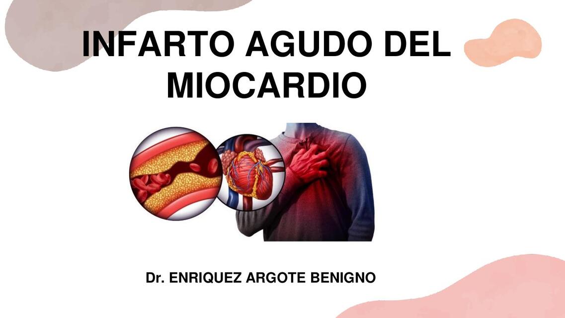 Infarto Agudo De Miocardio | Dr. ENRIQUEZ ARGOTE | uDocz