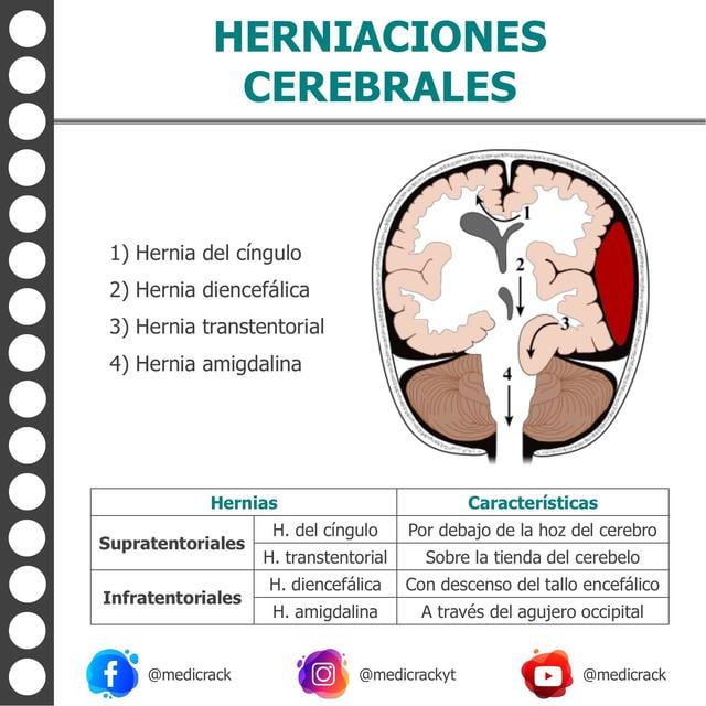 HERNIACIONES CEREBRALES | Medicrack | uDocz