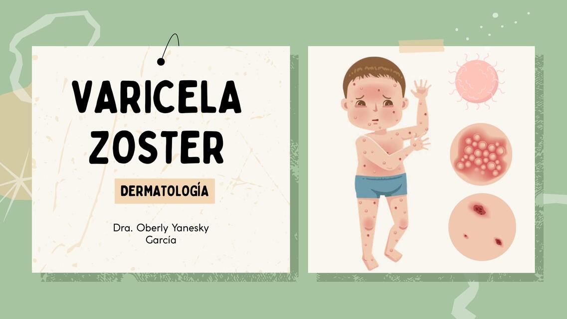 Flashcards de VARICELA ZOSTER | Por Alondra Solís | uDocz