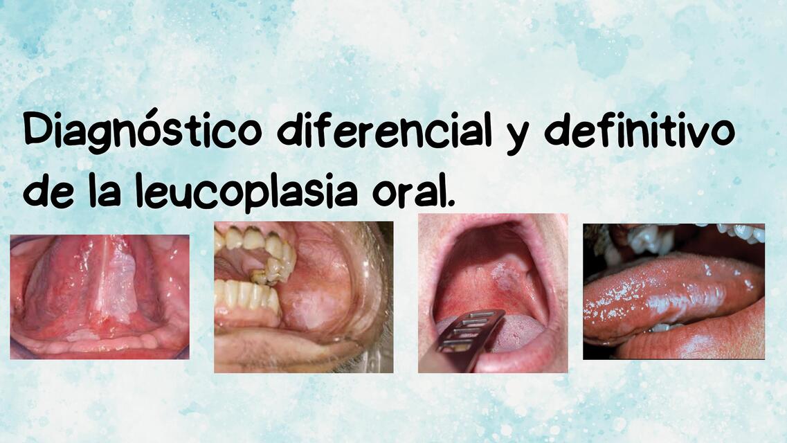 Diagnóstico diferencial y definitivo de la leucoplasia oral. | Liz KAL ...