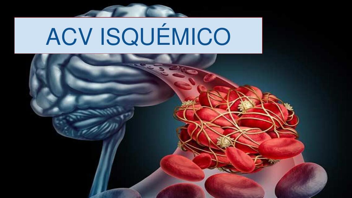 ACV ISQUÉMICO | Diversity | uDocz