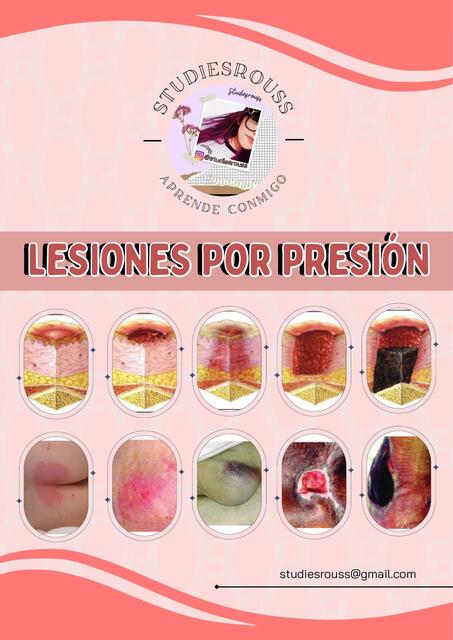 LESIONES POR PRESION | Studiesrouss | uDocz