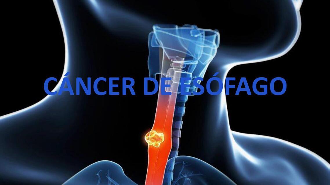 TUMORES DE ESOFAGO nuevo | Julienne Carvalho | uDocz