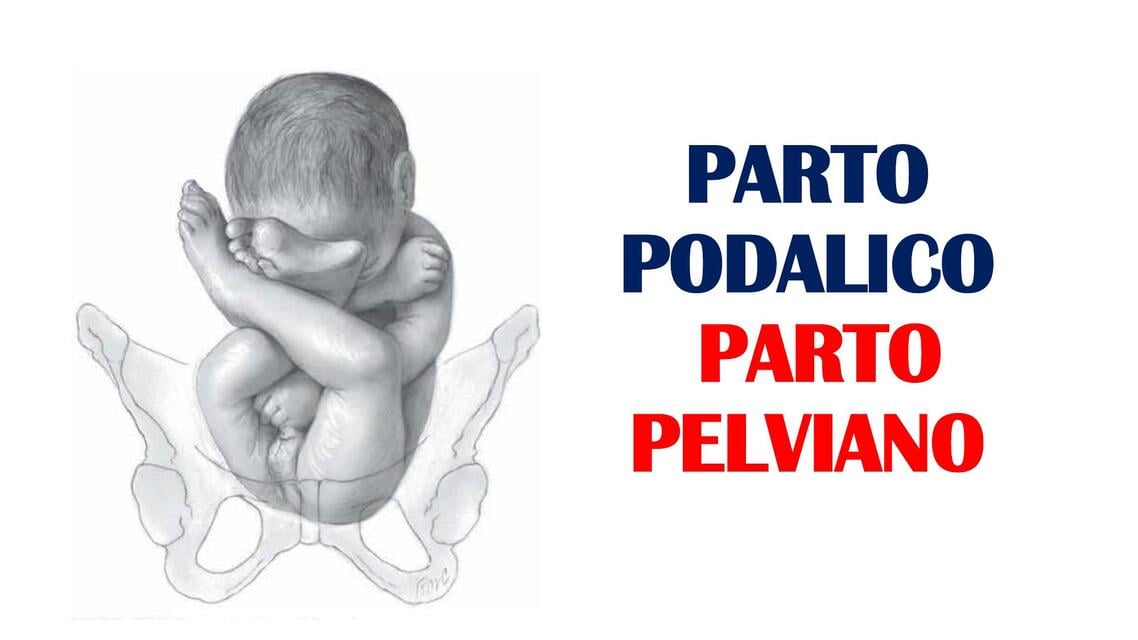 PARTO PODALICO - PARTO PELVIANO | Apuntes Medicos | uDocz