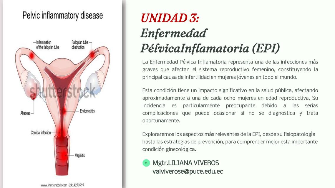 Enfermedad Pelvica Inflamatoria EPI 1 | anderson gonzalez | uDocz