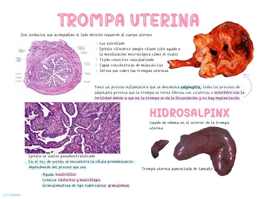 Neoplasias de la trompa uterina (patología) | Med Notes | Estudiante de ...