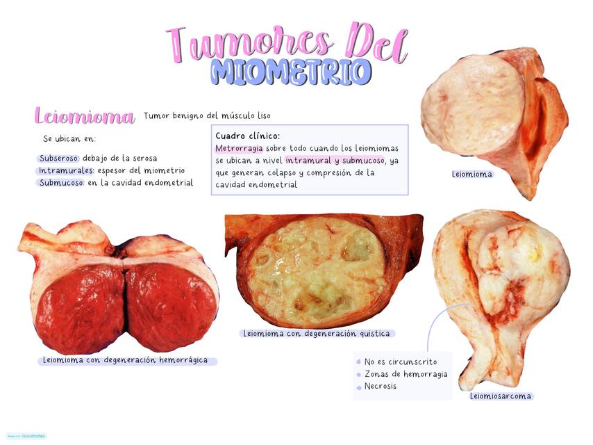 Tumores del miometrio (patología) | Med Notes | Estudiante de medicina ...