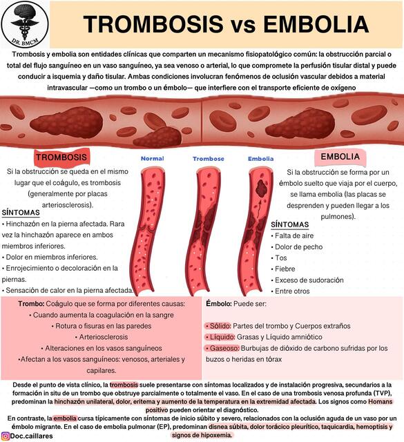 TROMBOSIS VS EMBOLIA | Dr. Boris Moises Caillares Montaño | uDocz